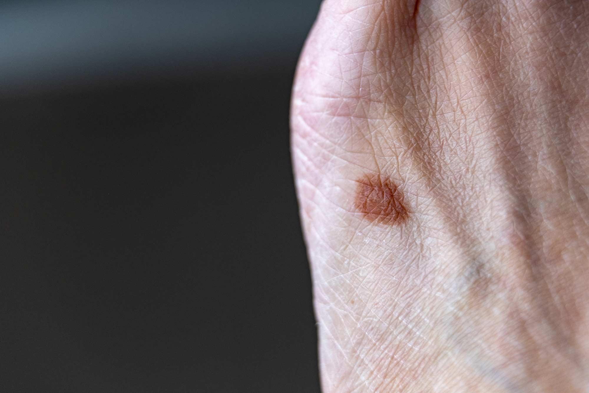 Foot Melanoma: Signs and Symptoms – Canyon Oaks Foot & Ankle